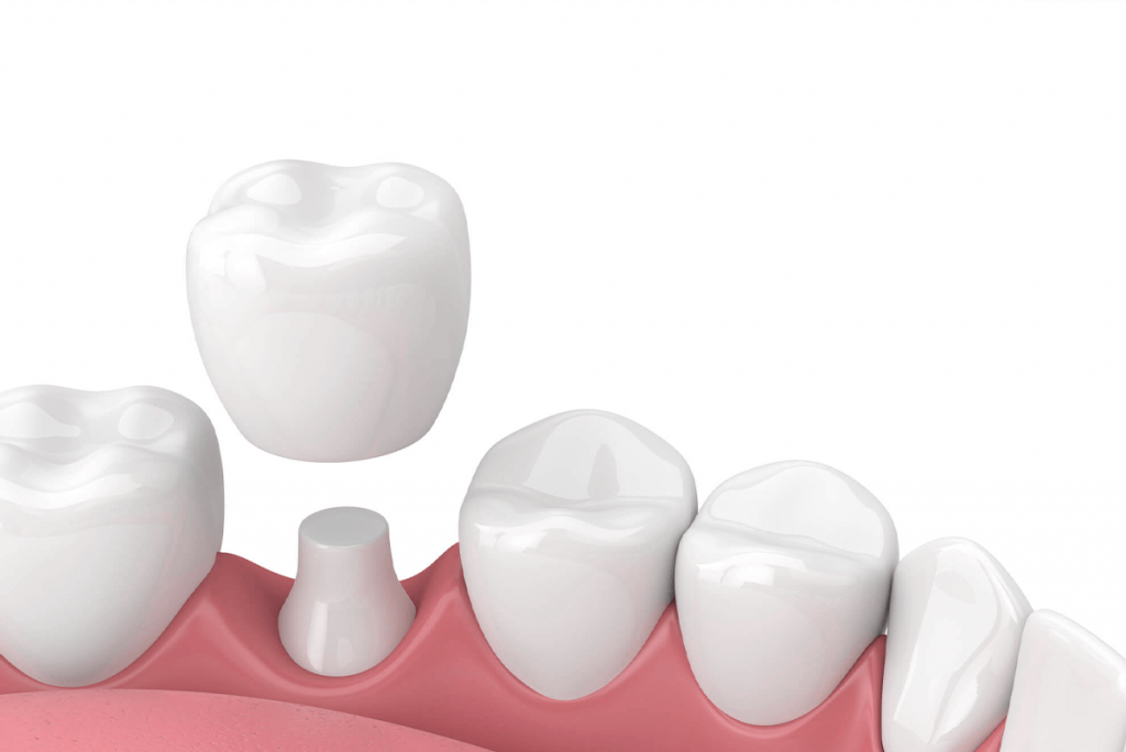 Corone dentali in ceramica integrale: la soluzione migliore per denti ...